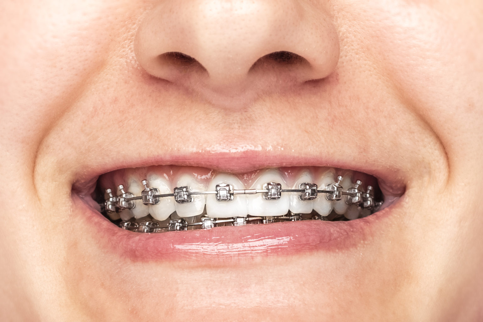 How to Fix an Overbite San Ramon CA | Protrusion Danville
