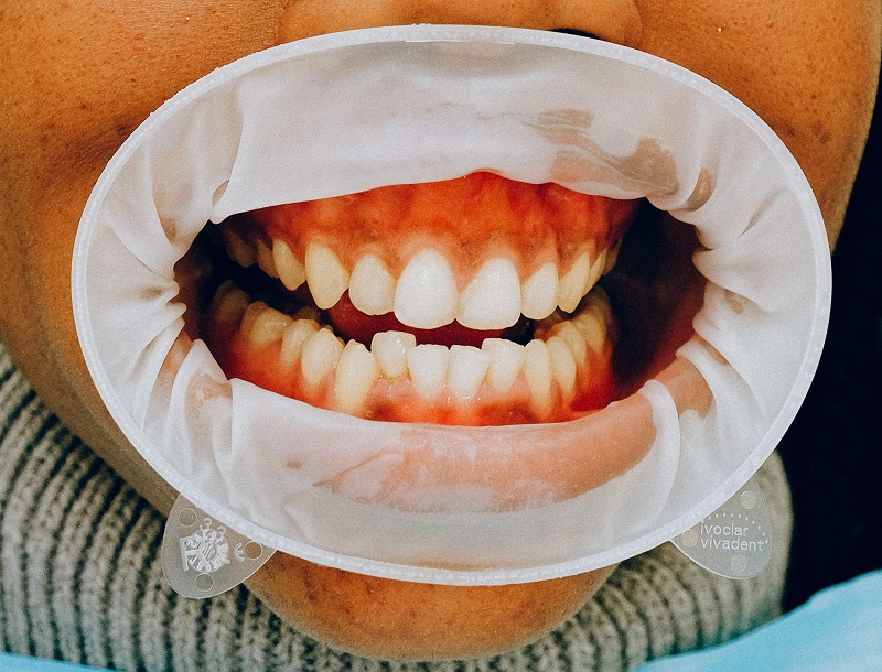 Do I Need Braces Dentist In San Ramon Ca